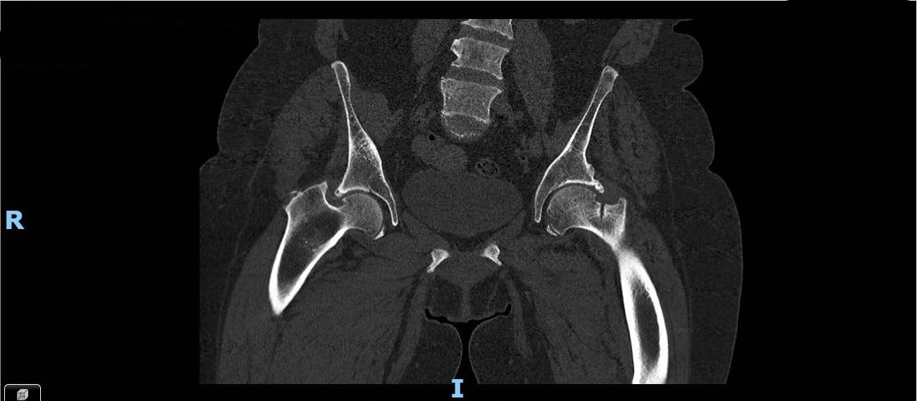 Initial Management of Hip Fractures in Adults - Doctorable