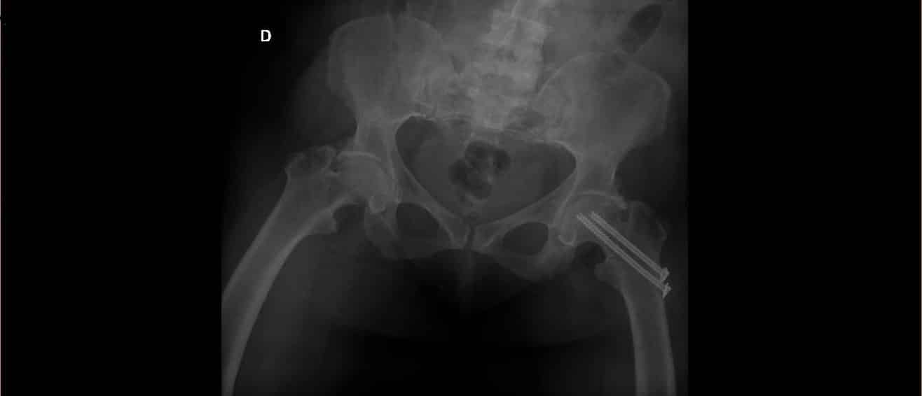 Initial Management of Hip Fractures in Adults - Doctorable