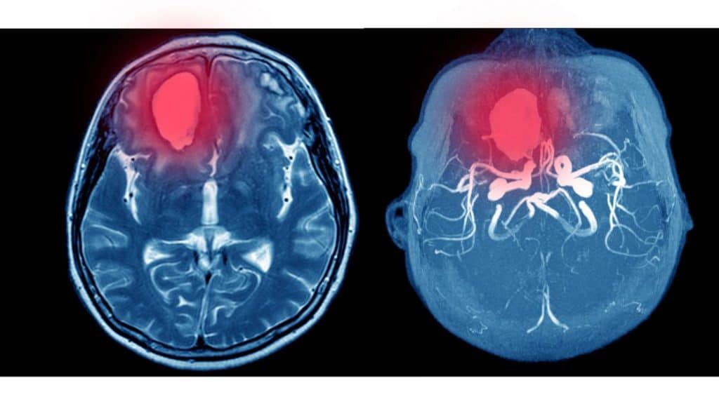 Acute Headache in Adults - Doctorable