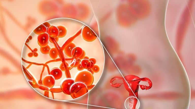 Vulvovaginitis: an Overview of Diagnosis and Management - Doctorable